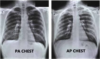 X-ray 검사 -chst AP,PA / Abdomen flat & upright / Decubitus, Oblique. KUB ...