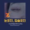 눈대상포진 빠른치료필수 단순히 넘기면 안되요 네이버 블로그