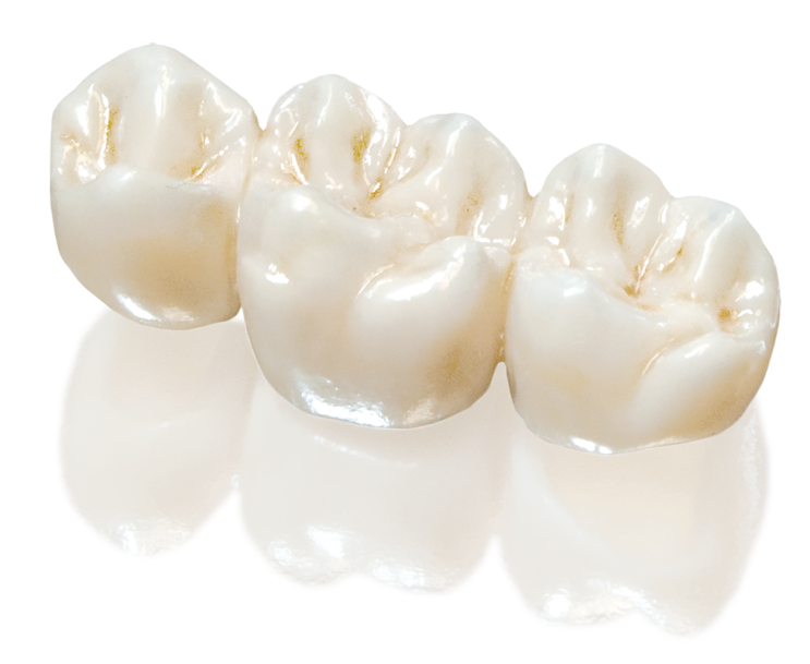 3M Lava Plus Zirconia/지르코니아/설명/특징 : 네이버 블로그