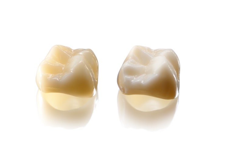 3M Lava Ultimate /라바/블럭/보철물/소개 : 네이버 블로그