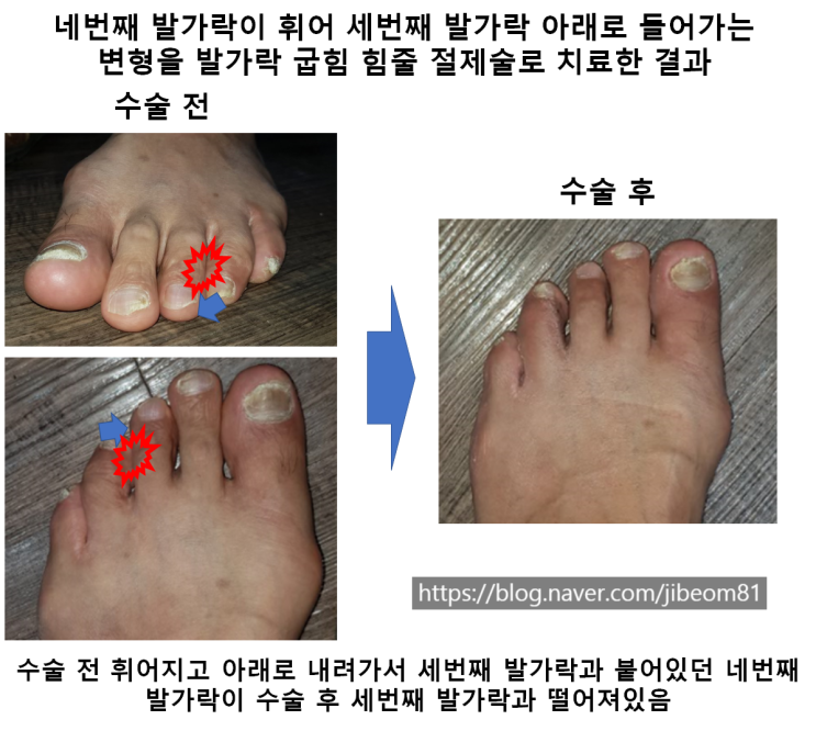 발가락의 변형 치료 네번째 발가락에 세번째 발가락 밑으로 들어가요 네번째 발가락의 굽힘 힘줄 절제수술 족부 정형외과