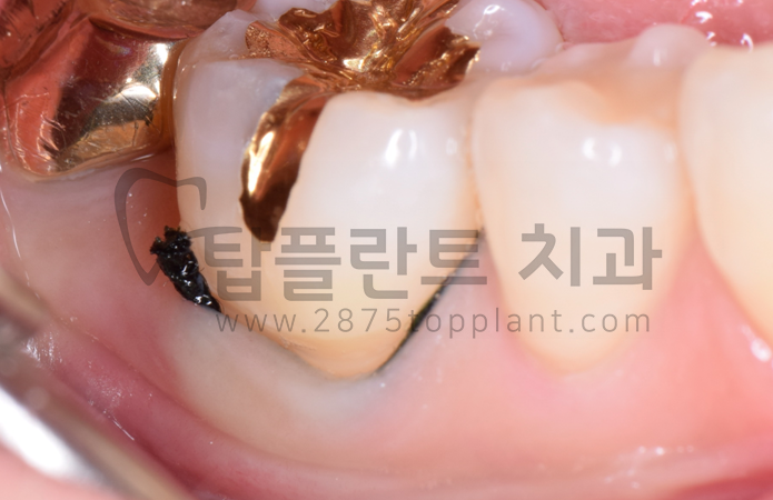 치경부 마모증레진 치료 케이스 부제치아가 시려요성남 금광동 탑플란트 치과 네이버 블로그