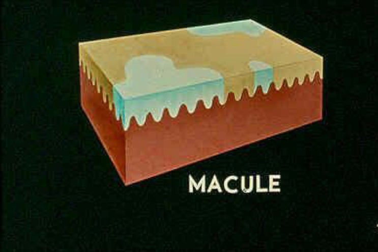[PK 생활] 피부과. pruritus, macule, papule, vesicle, bulla, pustule, wheal ...