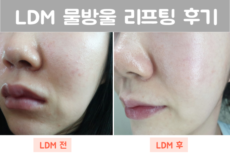 Ldm물방울 리프팅 후기 왜 이제야 했을까 네이버 블로그