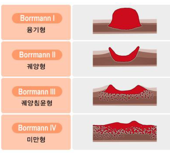 진행성위암 (Advanced gastric cancer, AGC), 보만(Borrmann type) 분류 : 네이버 블로그