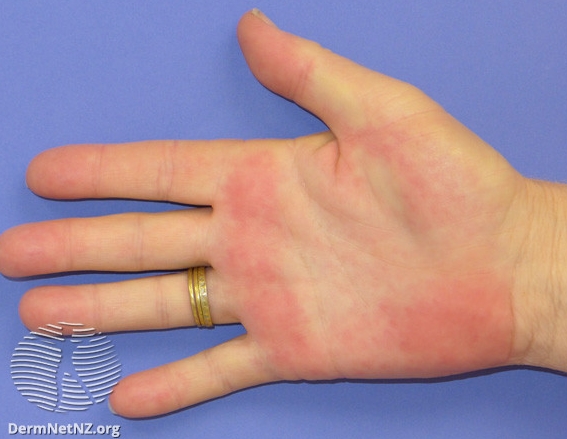 수장홍반, 손바닥홍반 (palmar erythema) : 네이버 블로그