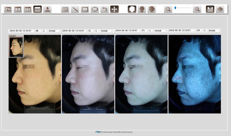 [최신 피부측정기/피부진단기/피부테스트기 마크뷰(Mark.Vu) 도입] 화곡 리뉴미피부과에서 최신장비로 피부측정을 받아보세요~ : 네이버 블로그