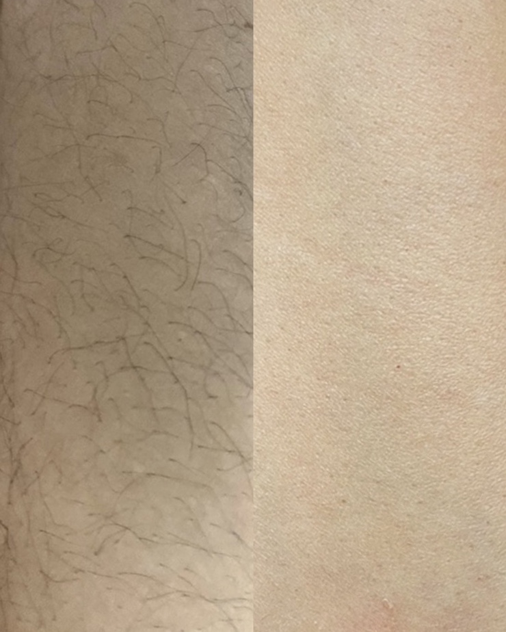 팔and겨드랑이 레이저제모 깔끔 후기 가격비댓 네이버 블로그