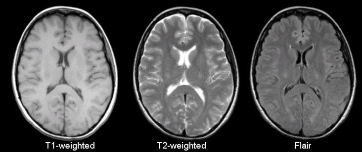 MRI weighting_T1 vs T2 비교 : 네이버 블로그