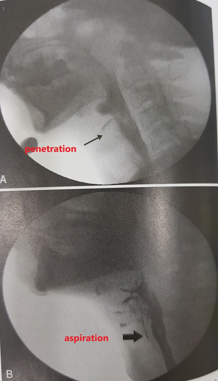 VFSS 검사 결과에서 사용되는 Penetration-Aspiration Scale(PAS) : 네이버 블로그