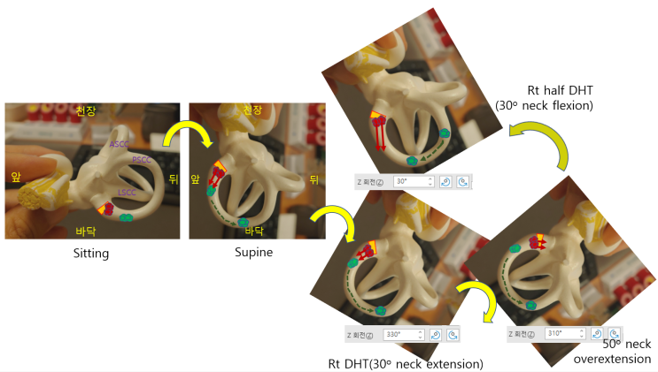 [uncommon BPPV] [case review] Posterior Canal cupulolithiasis ...