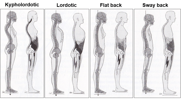스웨이백 / Sway Back(굽은등) 원인 자세 분석 운동 : 네이버 블로그