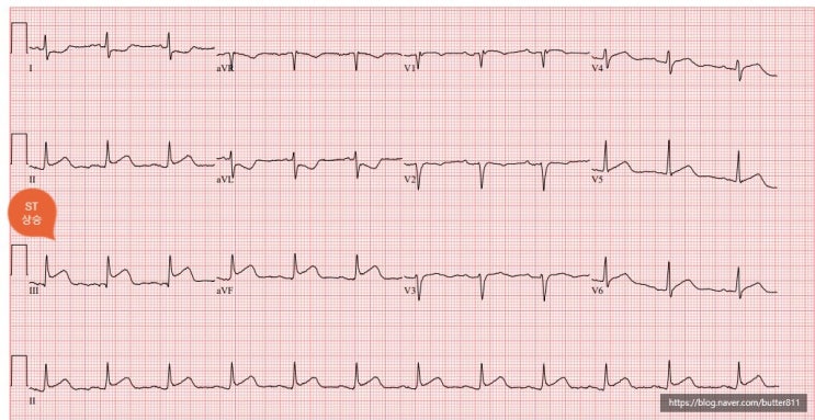 STEMI 환자 case : 네이버 블로그