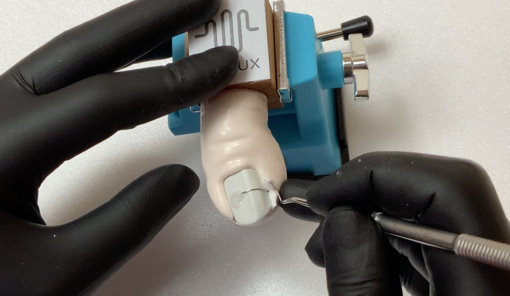 [헬룩스 hellux ] 2. one side brase (한방향 내성발톱 교정기) : 네이버 블로그