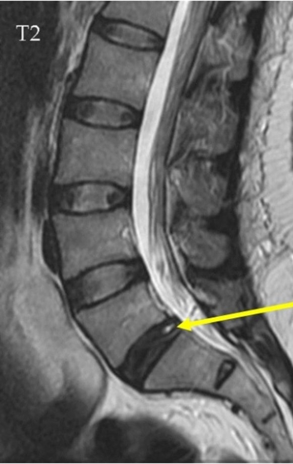 다리 통증 없고 허리 통증만 있는데 근육통이죠??? 디스크성 허리 통증(lumbar discogenic pain) : 네이버 블로그