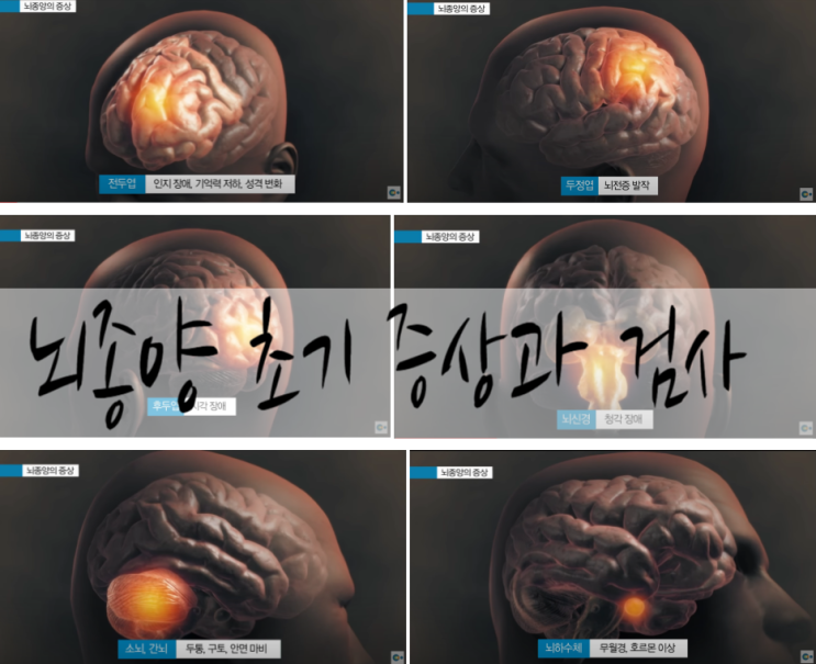악성양성 뇌종양 초기증상 원인 뇌 Mri 보험적용 네이버 블로그