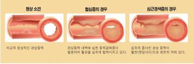 간호학 협심증약물종류 니트로글리세린 질산염제제 적응증부작용 용량투여경로 : 네이버 블로그