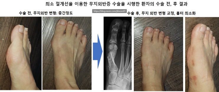 최소 절개를 이용한 무지외반증의 수술적 치료 엄지 옆에 튀어나온 부위가 아픈데 통증과 흉터를 최소화 할 수 있나요 족부