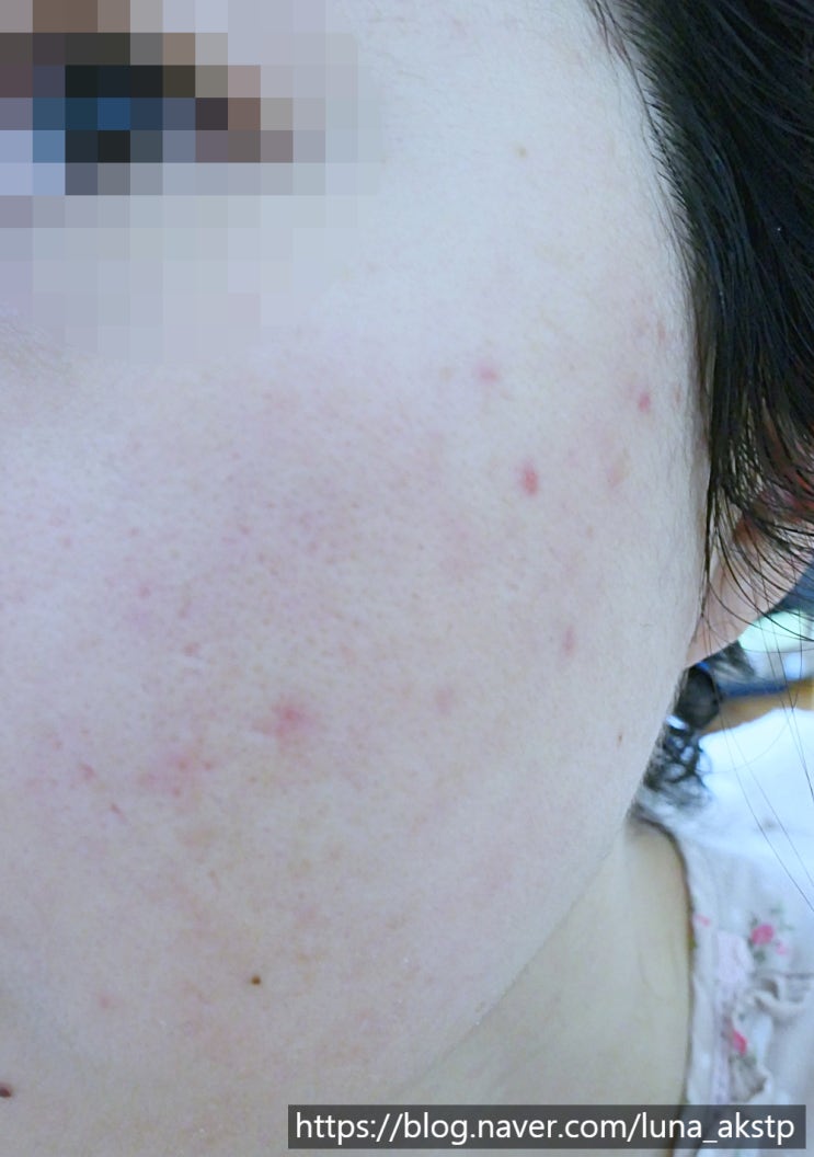 모낭염 여드름 차이 모낭염 피부과 치료 과정 후기연고 먹는 약 네이버 블로그