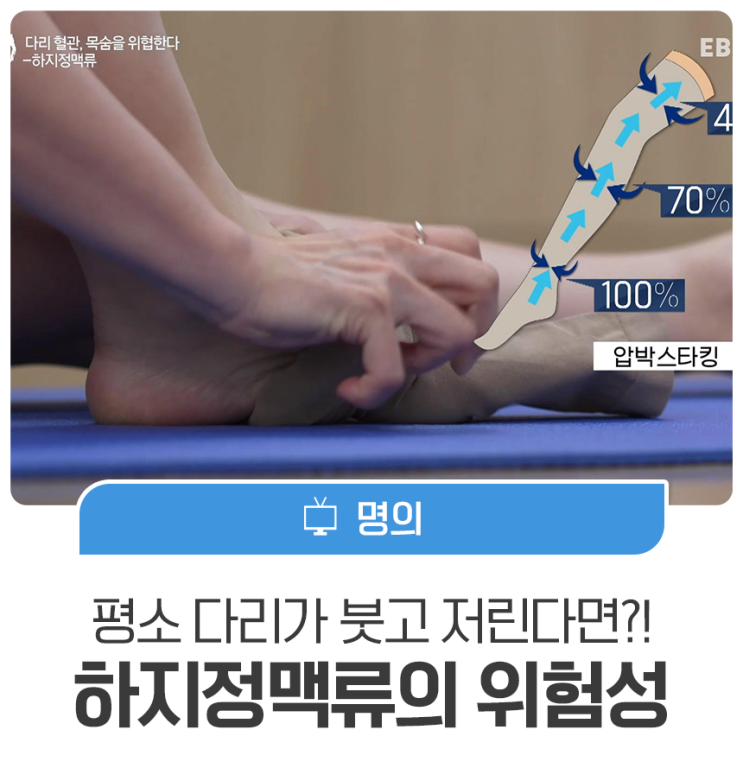 하지정맥류의 초기증상 치료법은 무엇일까 Ebs 명의 네이버 블로그