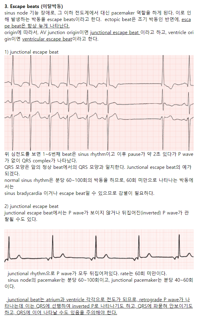 escaped beat(補充調律 보충조율) - wikipedia : 네이버 블로그
