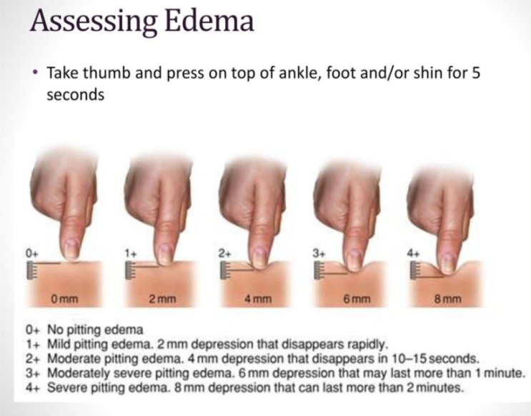 Pitting edema 측정/분류기준 : 네이버 블로그