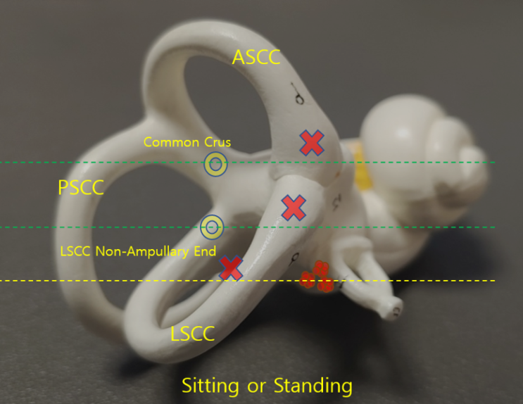 [BPPV] 수평세반고리관 관내결석증의 모든 것 7. LSCC Canalolithiasis의 정복술 이후 실시하는 Forced ...