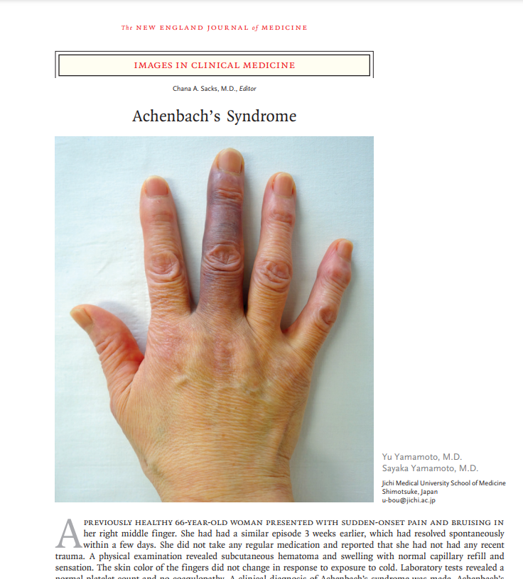 갑작스런 손가락 멍, 손가락 통증 : Achenbach syndrome(아첸바흐 신드롬) : 네이버 블로그
