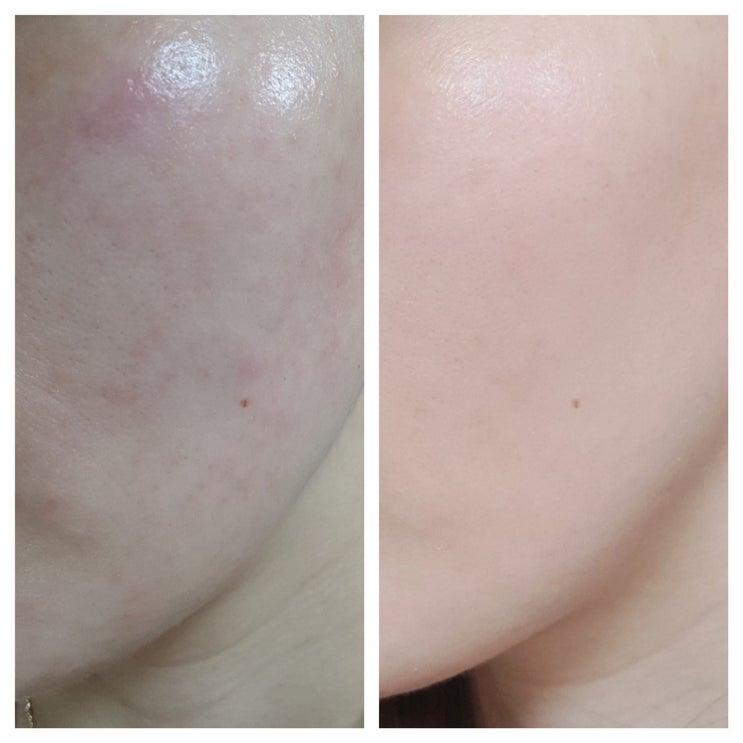수란트라 32일차 실비 처리 방법 모낭염 주사피부염 안면홍조 지루성피부염 날치알염증 수란트라 가격 네이버 블로그