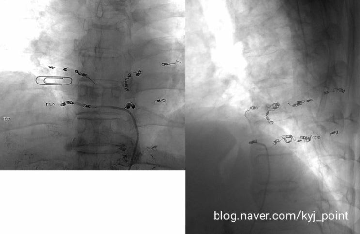 Spinal Tumor Embolization; 척추 종양 색전술 : 네이버 블로그