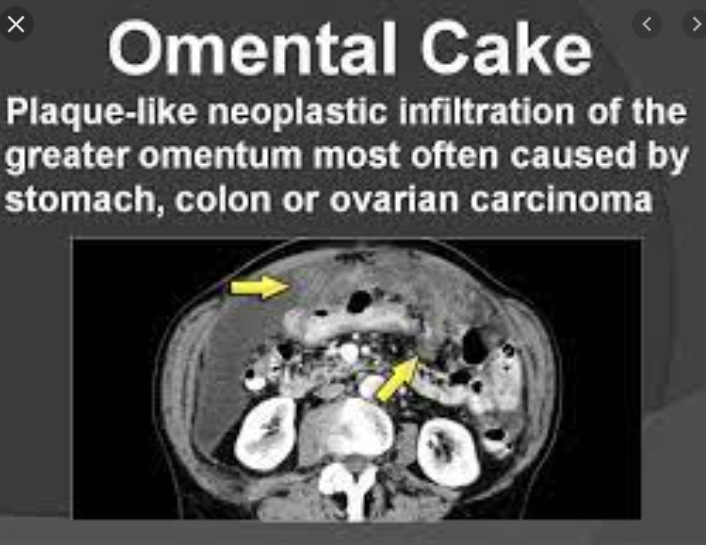 omentum, omental cake, omentectomy, debulking surgery, : 네이버 블로그