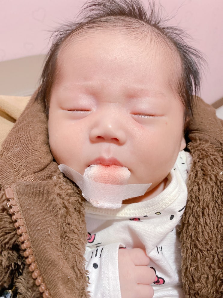 육아기록 신생아 육아종 배꼽 제대탈락 시기 배꼽 염증 설소대 수술 네이버 블로그