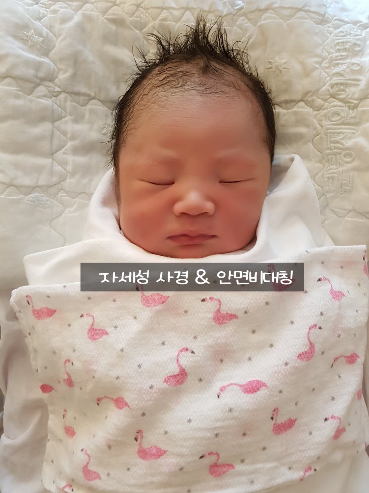 사경 재활교실 5강 자세성 사경 안면비대칭 치료 사례 아기 안면비대칭 신생아 사경 네이버 블로그