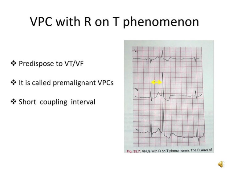 Ventricular Tachycardia / Ventricular Fibrillation : 네이버 블로그
