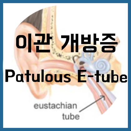 [귀] 이관 개방증(Patulous Eustachian tube) : 네이버 블로그