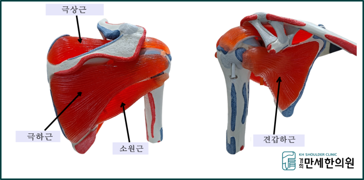 경희만세한의원 어깨근육이 찢어졌다는데요 꼭 수술을 해야하나요 회전근개 파열의 치료 네이버 블로그