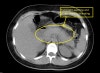 급성췌장염의 진단과 검사testing And Diagnosis Of Acute Pancreatitis 네이버 블로그