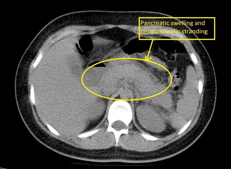 급성췌장염의 진단과 검사testing And Diagnosis Of Acute Pancreatitis 네이버 블로그