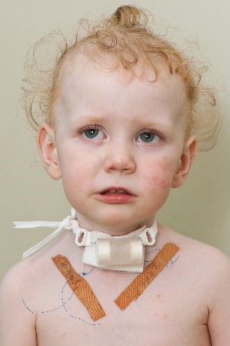 Tracheostomy HME(Heat moisture exchanger) : 네이버 블로그