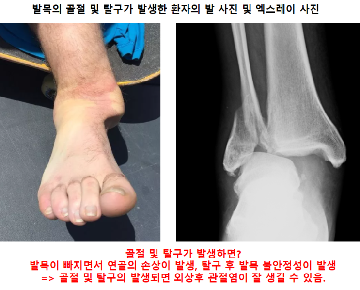 발목 골절후 관절염의 수술적 치료 발목이 부어서 신발 신기도 어려울 정도에요 발목도 너무 아파요발목관절유합술 족부 정형