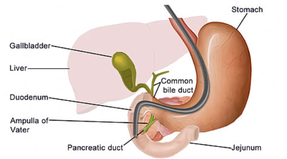 MRCP, ERCP, PTBD, PTGBD에 대해 알아보기 : 네이버 블로그