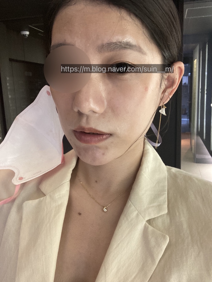 [시술후기] 신주쿠 울쎄라HIFU 4000샷 + 콤포트듀얼 400샷 / 태반주사 멜스몬 / ZARA 세일은 못 참지 ...