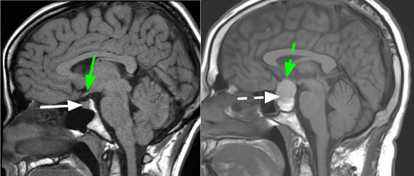 TSA (transsphenoidal approach), Pituitary adenoma : 네이버 블로그