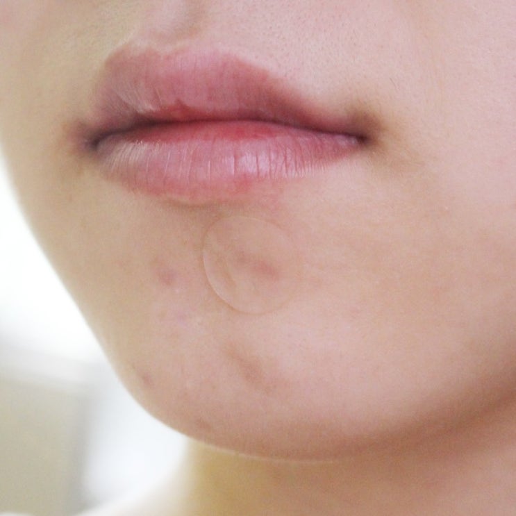 여드름패치추천 빠질 수 없는 메디폼 네이버 블로그