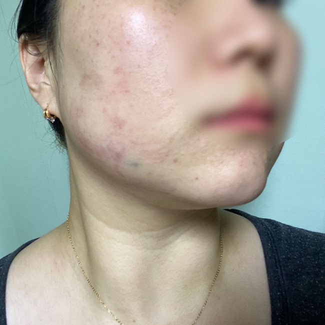대구인모드리프팅 동성로 윤곽주사 찐후기 네이버 블로그