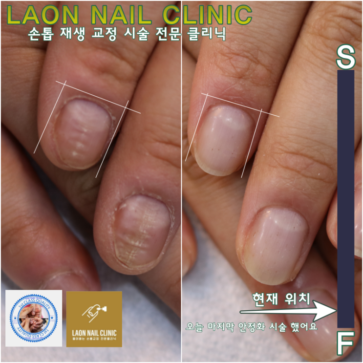 손톱이 울퉁불퉁 자라는 굴곡진 손톱 치료 방법은 완벽 결과 네이버 블로그