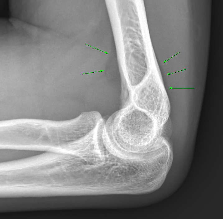 팔꿈치 골절 - fat pad sign. 1주일 후 X-ray 변화 : 네이버 블로그
