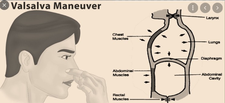 Valsalva maneuver(발살바 법) : 네이버 블로그