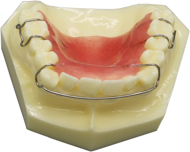 교정이 끝난 후 가철식 유지장치(hawley way, wrap around, clear retainer) : 네이버 블로그