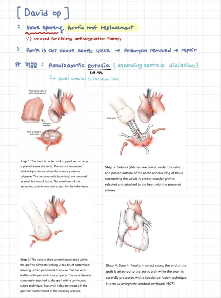 David procedure : 네이버 블로그